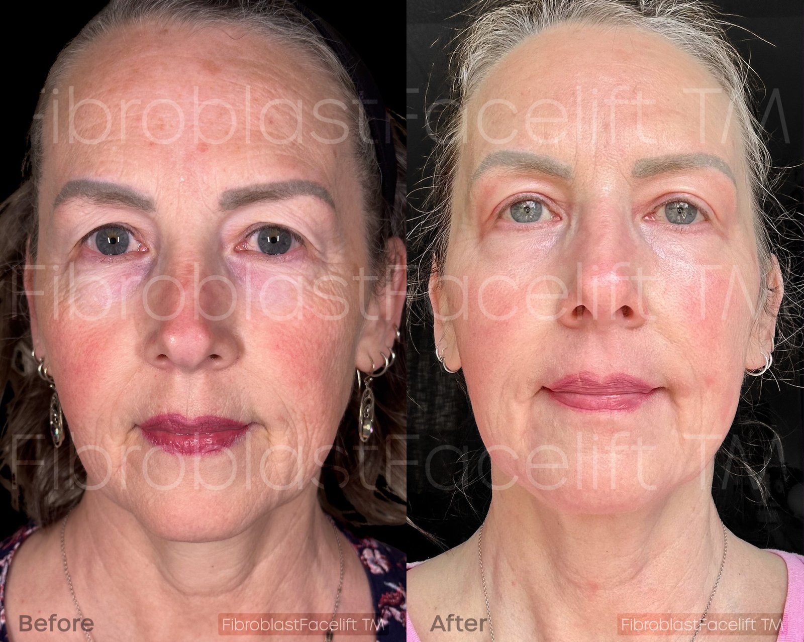Full Face - Fibroblast Facelift