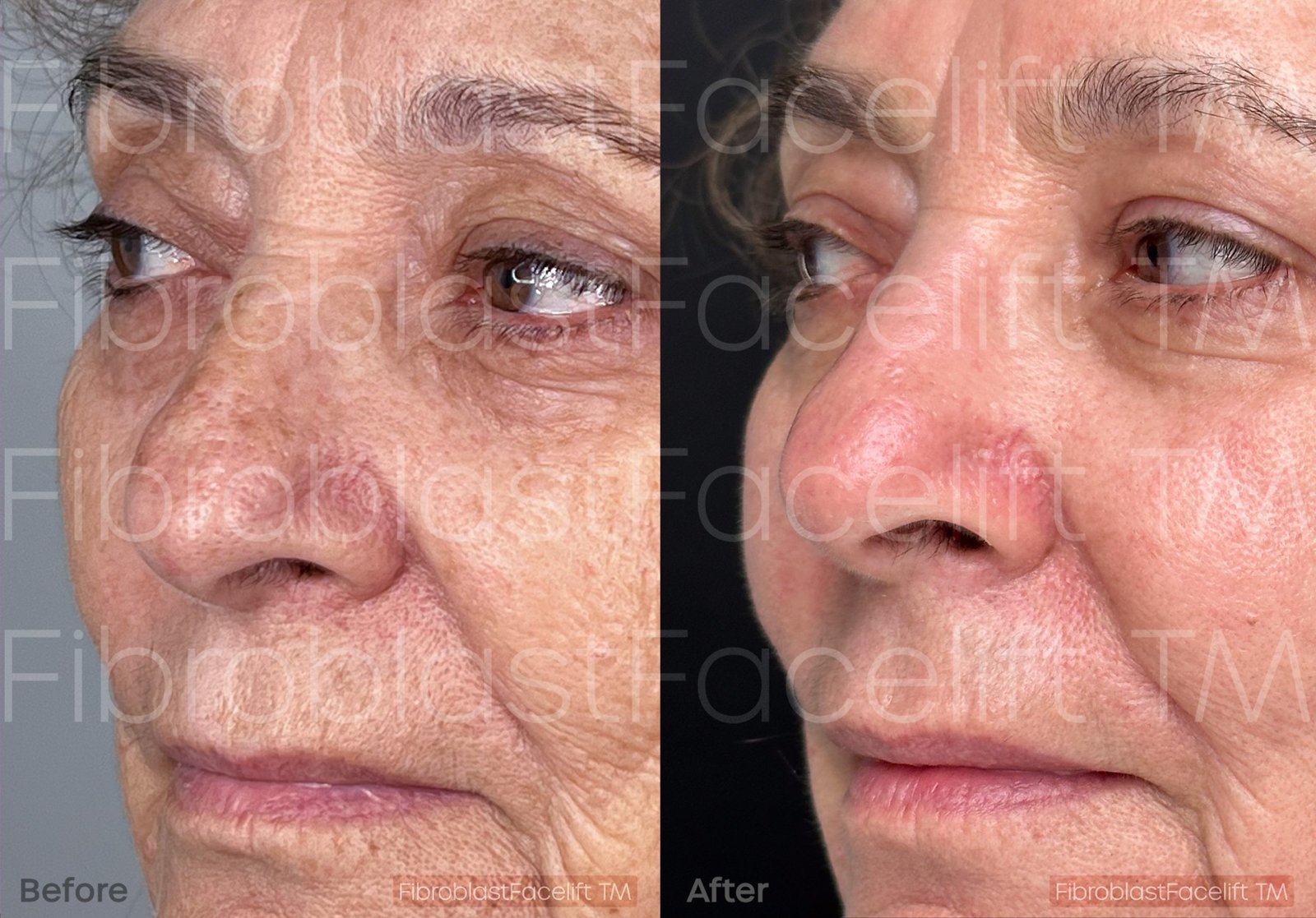 Non-surgical Nose Job - Fibroblast Facelift Non-surgical Nose Job - Fibroblast Facelift